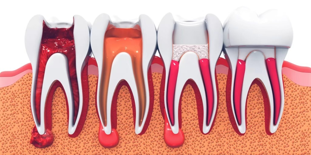 Ενδοδοντία - Dental Clinic