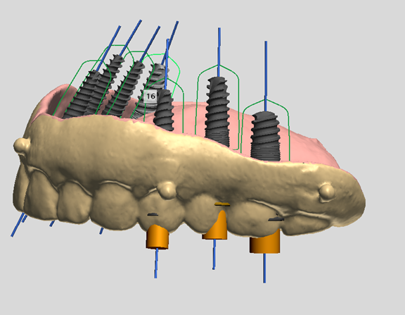 Implants - Dental Clinic